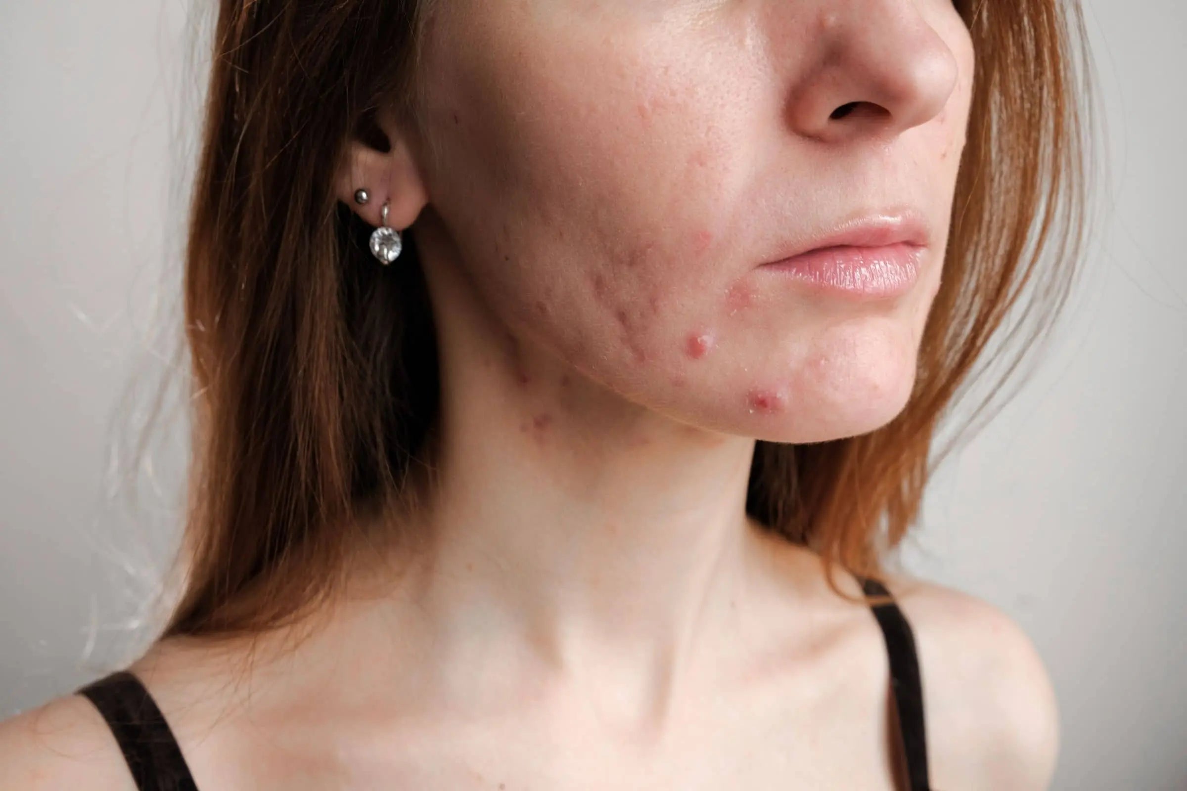 Hormonal vs. Bacterial Acne: Here’s How to Tell Which Type You Have ...